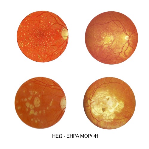 Ηλικιακή εκφύλιση ωχράς | ofthalmiatros-pampoukidou